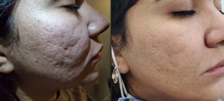 Traitement avancé des cicatrices d’acné | Clinique Infinium | Gatineau ...