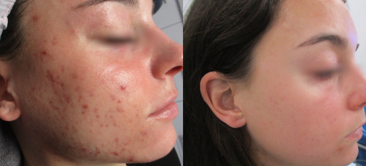 Traitement avancé des cicatrices d’acné | Clinique Infinium | Gatineau ...