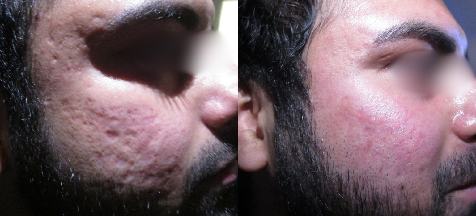 Traitement avancé des cicatrices d’acné | Clinique Infinium | Gatineau ...